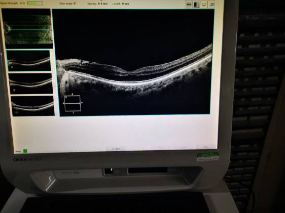 Zeiss Cirrus 500 OCT with Ant Seg | Used OCT | Ophthalmic Equipment ...