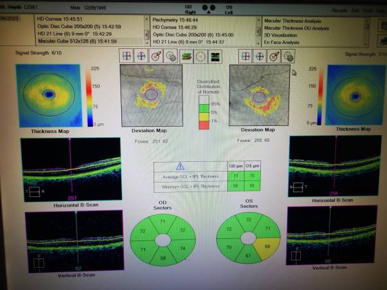 Zeiss Cirrus 500 OCT with Ant Seg | Used OCT | Ophthalmic Equipment ...